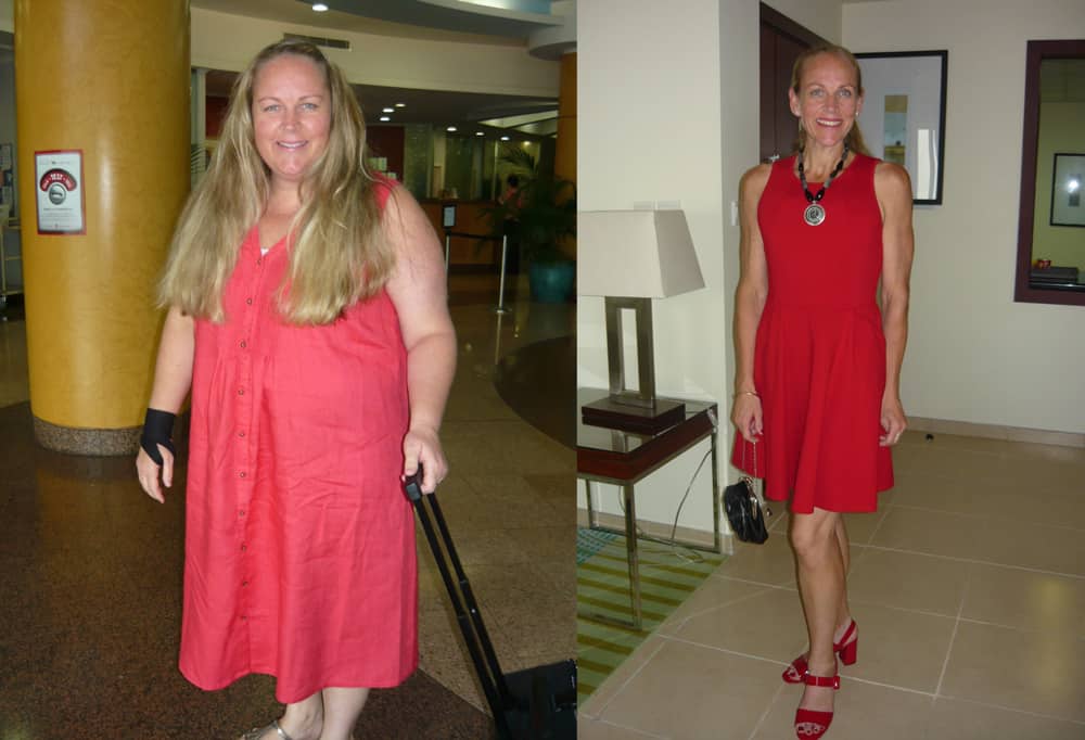 Jo-Anne Weight Loss Surgery Testimonial | Advanced Surgicare